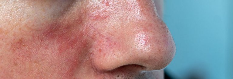 Psoriasis du visage : comment se manifeste-t-il